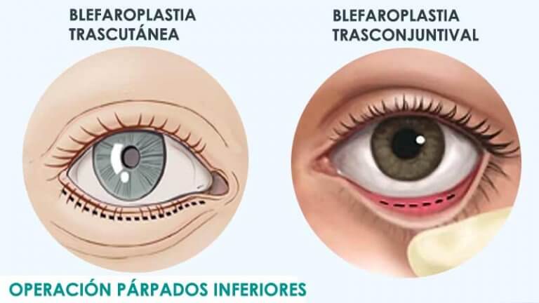 Operación de párpados inferiores en Madrid - Dr. Macía Colón