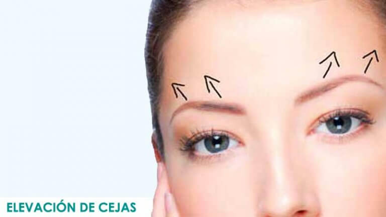 Elevación de cejas en blefaroplastia - Dr. Macía Colón - 1ª Consulta Gratis
