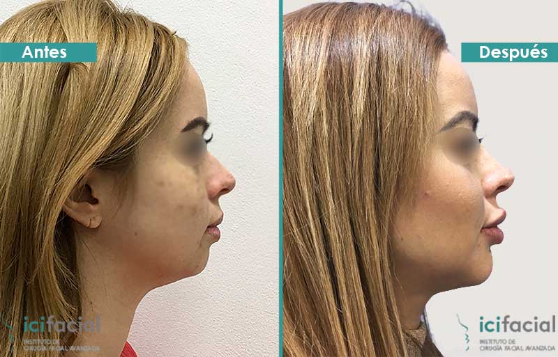 Mentoplastia en Madrid - Cirugía del mentón con Doctor Macía Colón